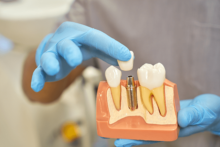 Dental Implant Treatment: The Perfect Solution for Missing Teeth ...