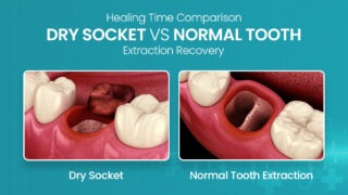 Smoking After Tooth Extraction: Risks, Alternatives, and Recovery Tips