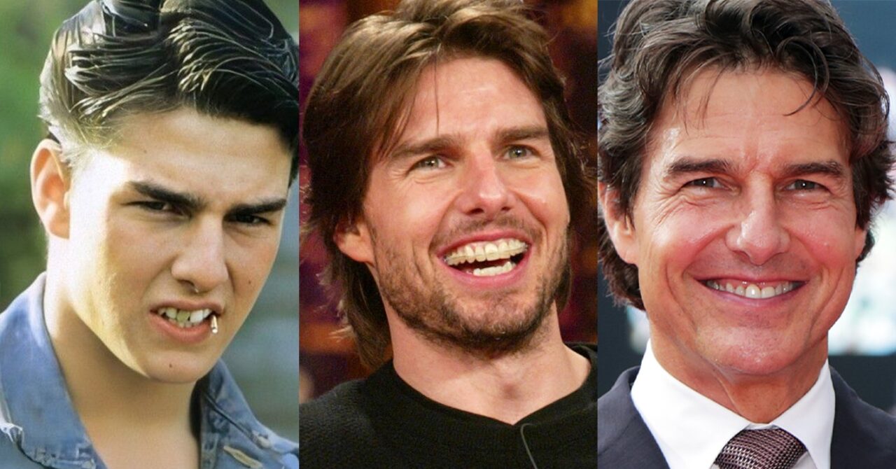 Celebrities With Veneers: The Secret Behind Their Perfect Smiles ...