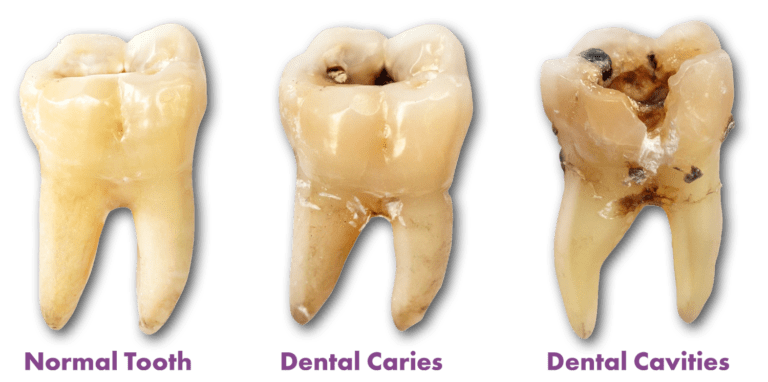 Cavity vs Stain: How to Identify and Treat Both - Parla Clinics
