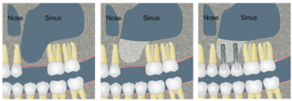 Sinus Lift Surgery: Everything you need to know - Parla Clinics